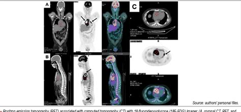 Pdf Primary Cardiac Angiosarcoma Evaluated On Petct Semantic Scholar
