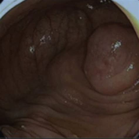 Inverted Appendix Normal Variant Download Scientific Diagram