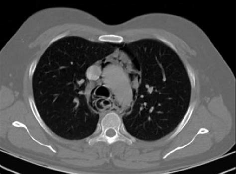 Chest Ct On Admission Demonstrated A Bilateral Pneumothoraces Download Scientific Diagram