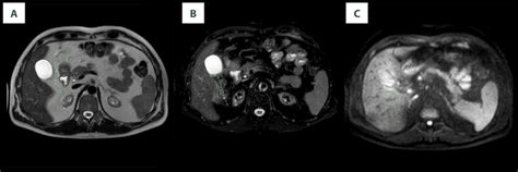 Abdominal Ct Axial Images At The Gallbladder Level Arrows A