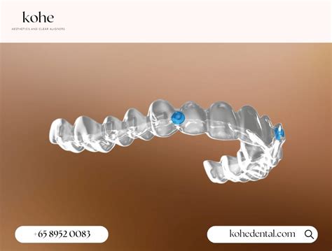 What Exactly Are Angel Aligners • Kohe™ Dental