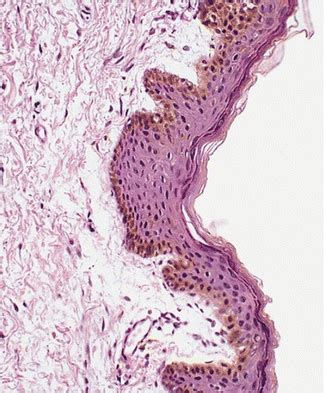 Dermatological Disease Of The Penis Abdominal Key
