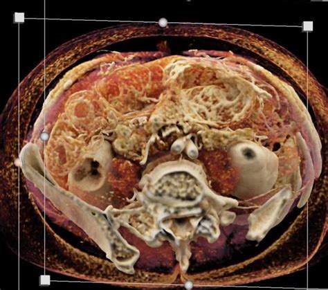 Gastric Gist Tumor Stomach Radiology Case Studies Ctisus Ct Scanning