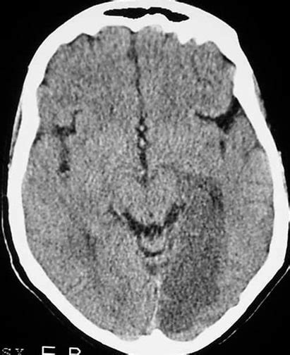 Posterior Cerebral Artery