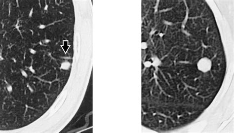 Figure 2 From Intrapulmonary Lymph Nodes Thin Section Ct Findings Pathological Findings And