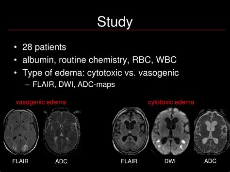 Ppt Type Of Edema In Pres Depends On Serum Albumin Powerpoint