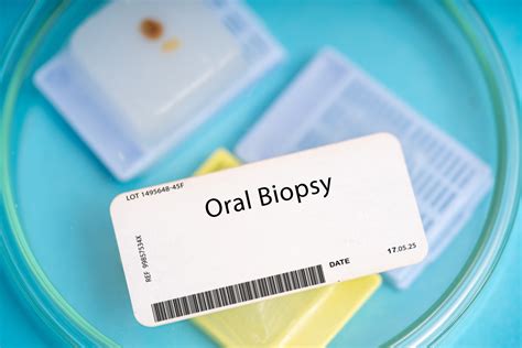 Oral Biopsy Sydney Moss