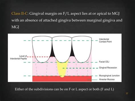 Gingival Recession Classifications Pptx Dental Health Diseases And Conditions