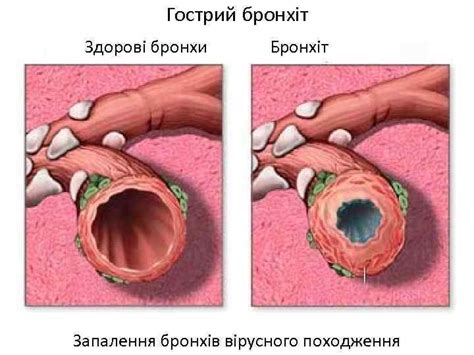 Хвороби дихальної системи Причини захворювання дихальних шляхів