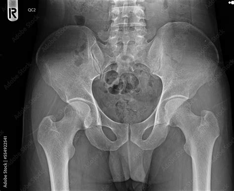 X Ray Of A Pelvic Stock Photo Adobe Stock