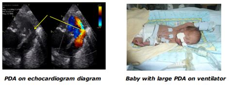 Patent Ductus Arteriosus Cuh