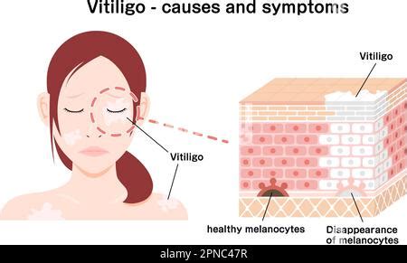 Causes And Symptoms Of Vitiligo Vector Illustration Stock Vector Image