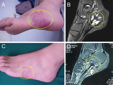 Diffuse Infiltrative Type IMVM In The Left Foot A The Immediate Download Scientific Diagram