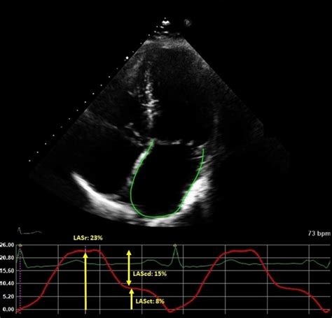 Example Of La Strain Curve In A Patient With Obesity Lasr Left Atrial Download Scientific
