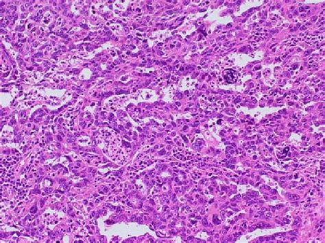 Histologic Image Of Endometrial Serous Carcinoma With A Basophilic Look