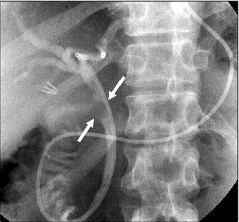 An Ovoid Filling Defect Is Noted In Mid Cbd Level Which Resulted In