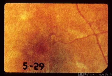 Toxocara Canis Retina Image Bank