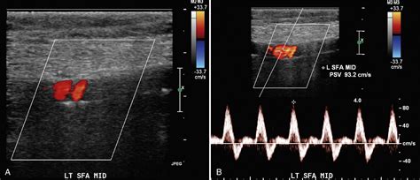 Femoral Artery Ultrasound Waveform