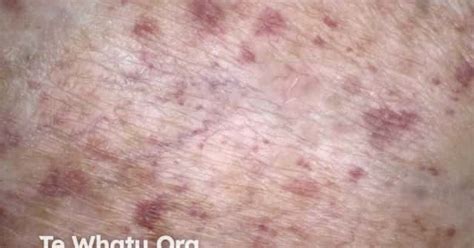 Dermoscopy Of Capillaritis Image