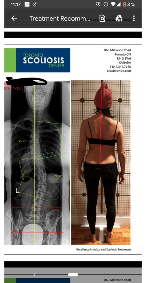 Scroth Therapy Results 34f R Scoliosis