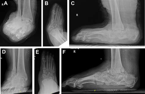Treatment Of Ankle And Hindfoot Charcot Arthropathy Foot And Ankle