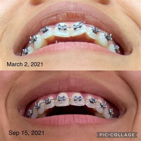 6 Months Progress R Braces