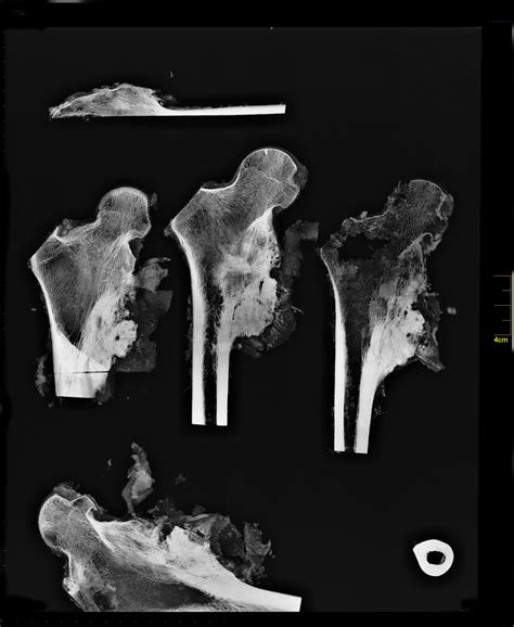 Bone Chondroblastic Osteosarcoma Lmp81748 Lmp Digital Laboratory