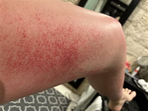 Leg Rash R Diagnoseme