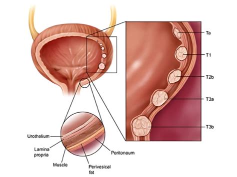 TURBT Procedure For Bladder Tumors Benefits Recovery