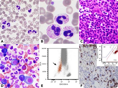 Leukemoid Reaction Definition Causes Symptoms Diagnosis And Treatment