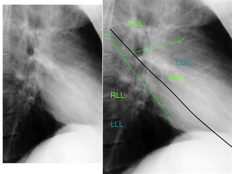 1 The Normal Cxr Ppt