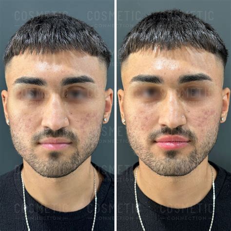 Asymmetrical Face Exercises