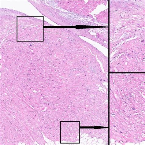 Technique 3 New Technology Used For Homogeneous Scar Tissue Creation