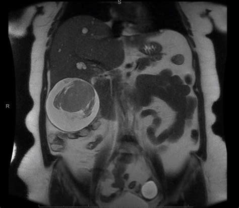 Exophytic Peripheral Cystic Lesion With Central Solid Non Enhancing