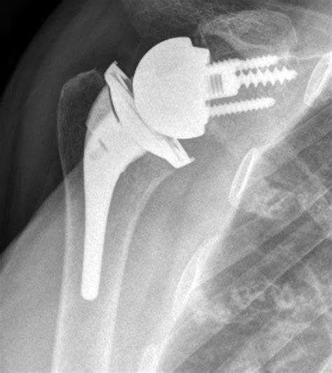 Inset™ Reverse Total Shoulder System Shoulder Innovations
