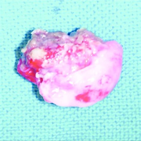 Excised Specimen Of Sequestrum With Granulation Tissue Download