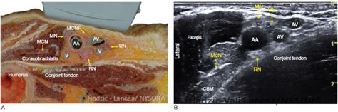 Axillary Brachial Plexus Block