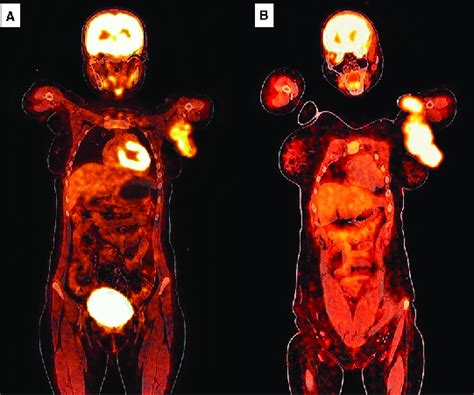 Extraskeletal Ewing Sarcoma Comparative Positron Emission Tomography Ct Download Scientific