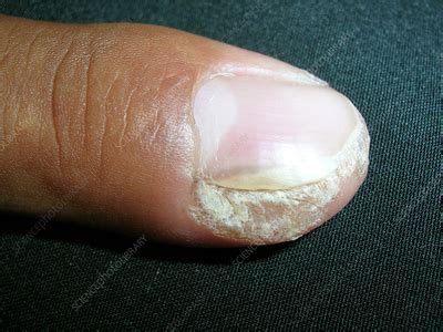 Fingernail Warts Periungual Warts Springerlink