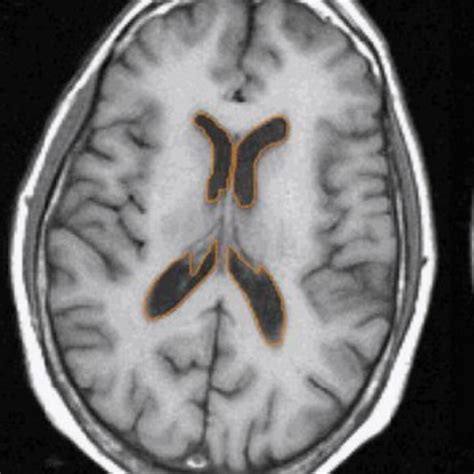 Braintumorsegmentationskullstripped Kaggle