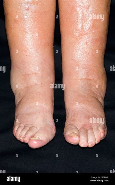 Oedema Swelling Of The Ankles Of The Legs Of An Adult Female Patient