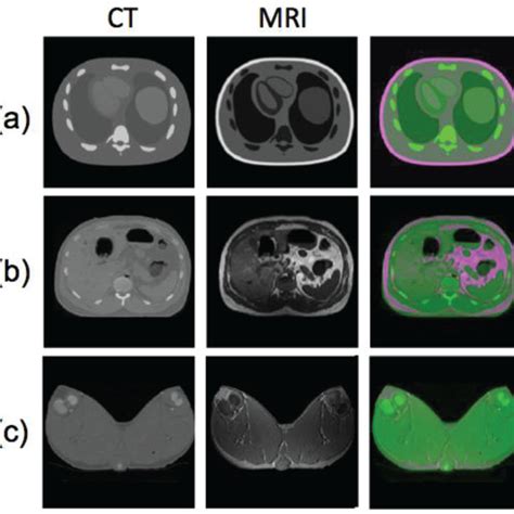 Pdf Simultaneous Ct Mri Reconstruction For Constrained Imaging