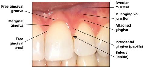 Free Gingival Groove