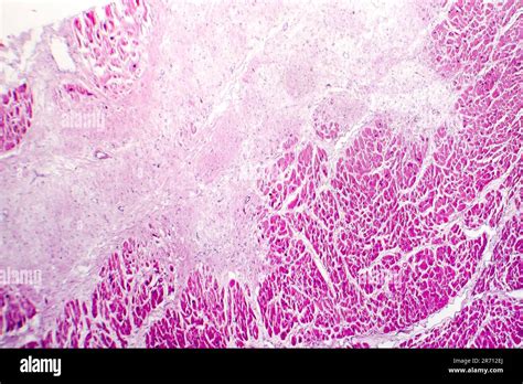 Myocardial Infarction Pathology