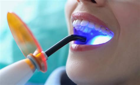 Teeth Bleaching Steps Dental Land Dental Clinic