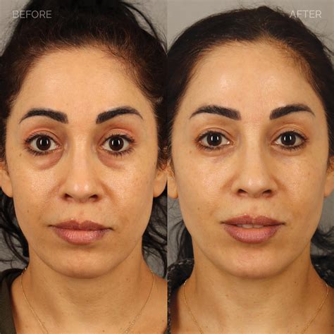 Lower Eyelid Filler With Cheek Filler Cabinmd Facial Plastics