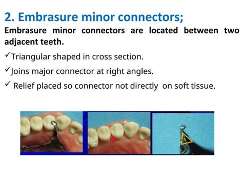 5 Minor Connectors Removable Partial Denture Ppt Dental Health