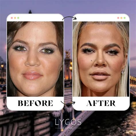 Khloe Kardashian Rhinoplasty Celebrities Nose Job