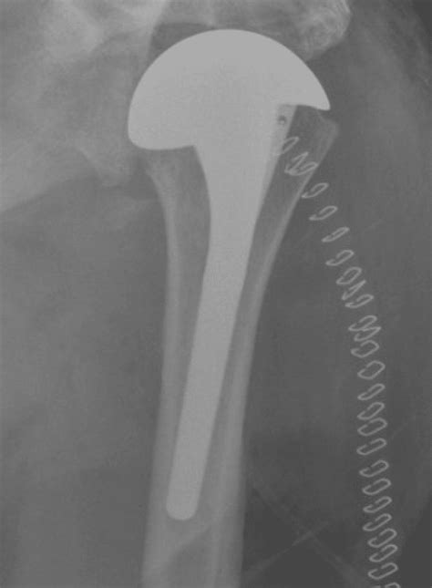 Tornier Affiniti American Shoulder And Elbow Surgeons