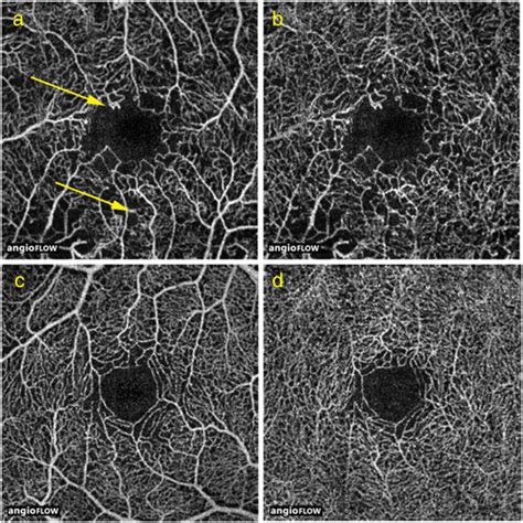 OCT A Of Proliferative Diabetic Retinopathy A And B Compared With An Download Scientific